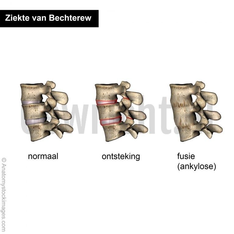 Bechterew - GEWRICHT.nl