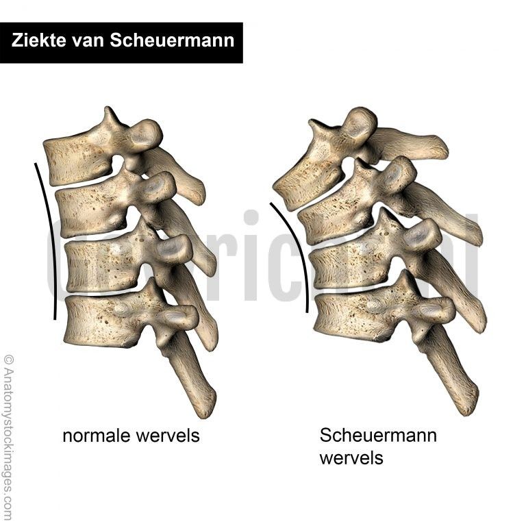 Scheuermann - GEWRICHT.nl